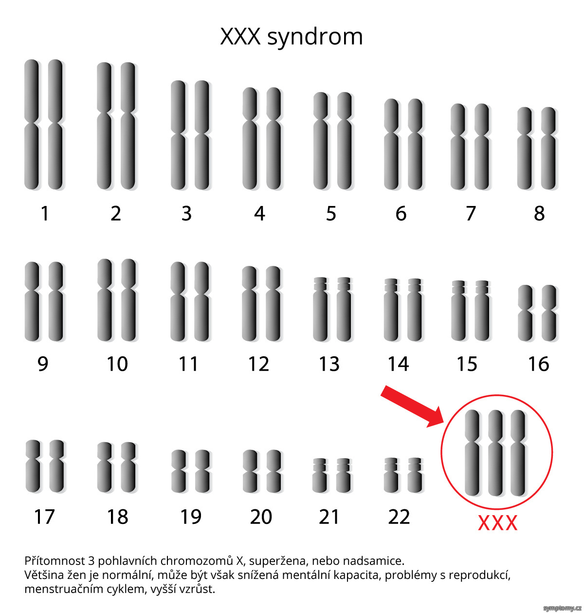 XXX Syndrom P znaky A L ba XXX Syndrom P znaky A L ba