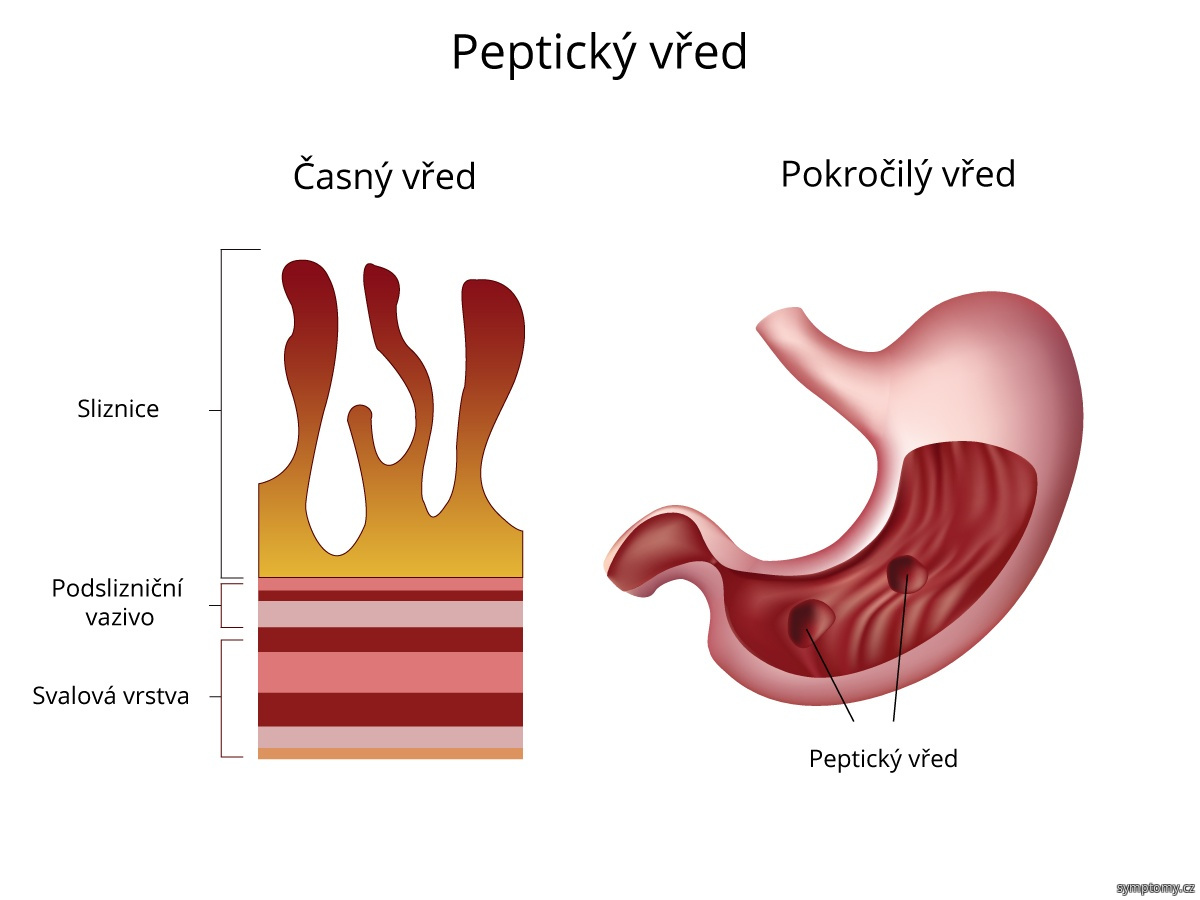 Žaludeční vředy - příznaky a léčba